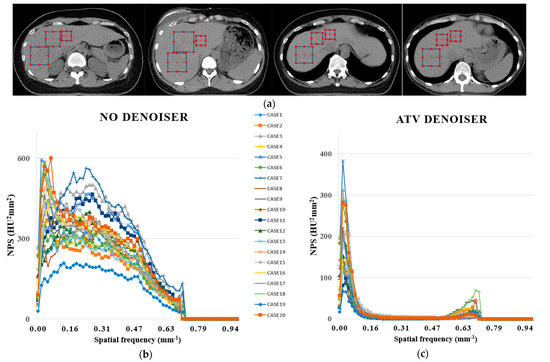 Impact of Denoising on Deep-Learning-Based Automatic Segmentation ...