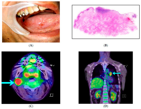 Diversity of the Origin of Cancer Stem Cells in Oral Squamous Cell ...