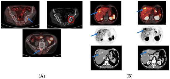 Clinical Applications of PSMA PET Examination in Patients with Prostate ...