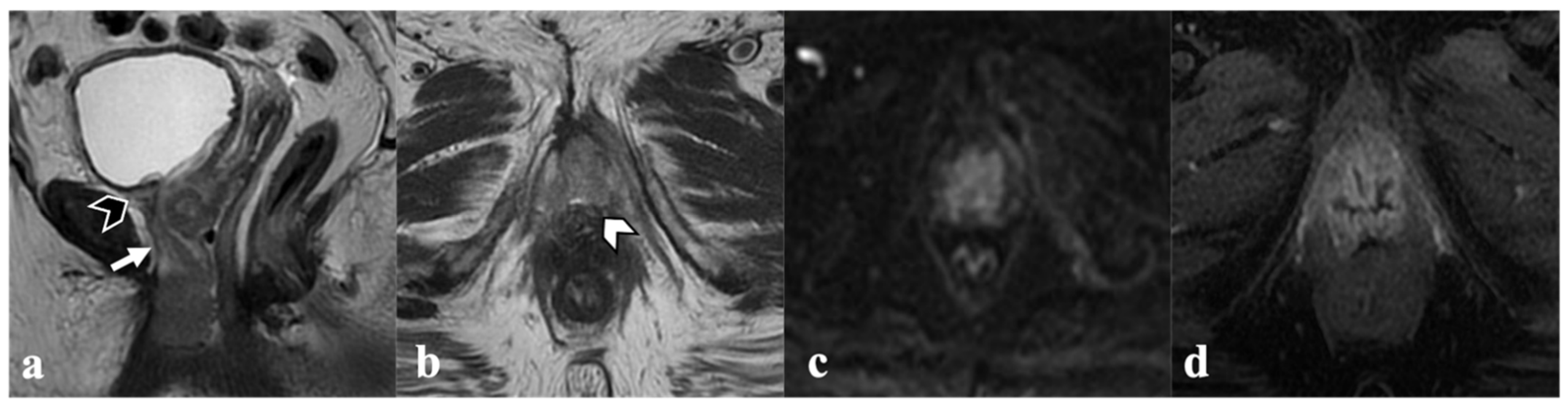 Cancers Free Full Text Mri In The Evaluation Of Locally Advanced