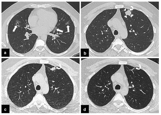 Possible Bias in Supervised Deep Learning Algorithms for CT Lung Nodule ...