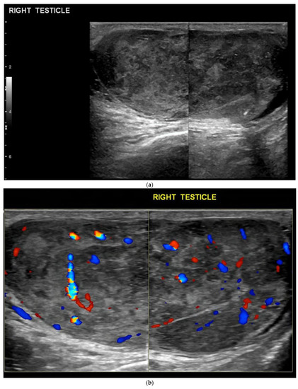 Testicular Germ Cell Tumours—The Role of Conventional Ultrasound