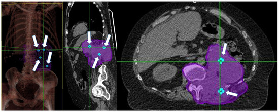 Impressive Results after “Metabolism-Guided” Lattice Irradiation in ...