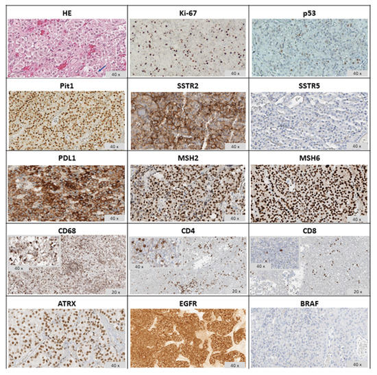 Immunotherapy for Aggressive and Metastatic Pituitary Neuroendocrine ...