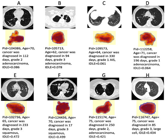 Cancers | Free Full-Text | Lung Cancer Recurrence Risk Prediction ...