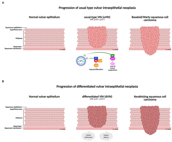 Cancers | Free Full-Text | Management of Early-Stage Vulvar Cancer