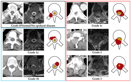 Diagnostic Accuracy of CT for Metastatic Epidural Spinal Cord Compression