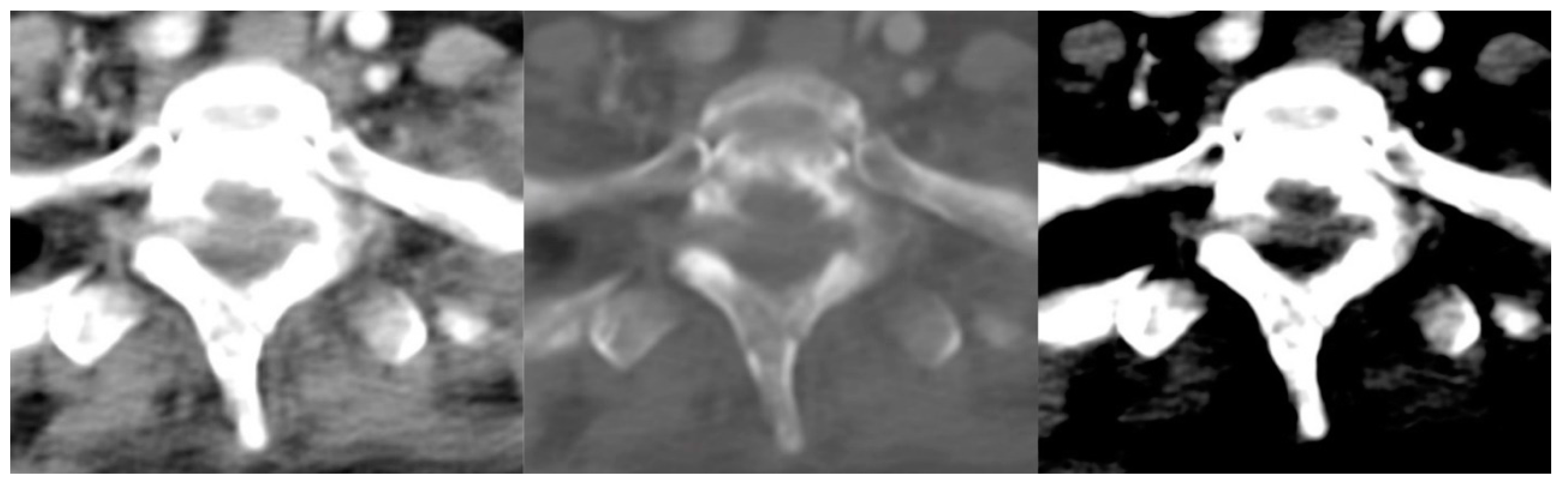 Diagnostic Accuracy of CT for Metastatic Epidural Spinal Cord Compression