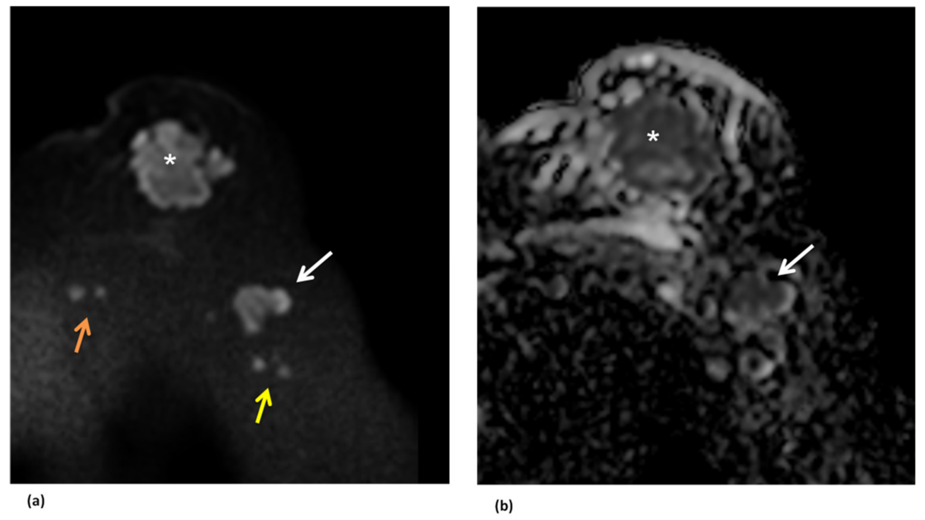 Beyond N Staging in Breast Cancer: Importance of MRI and Ultrasound ...