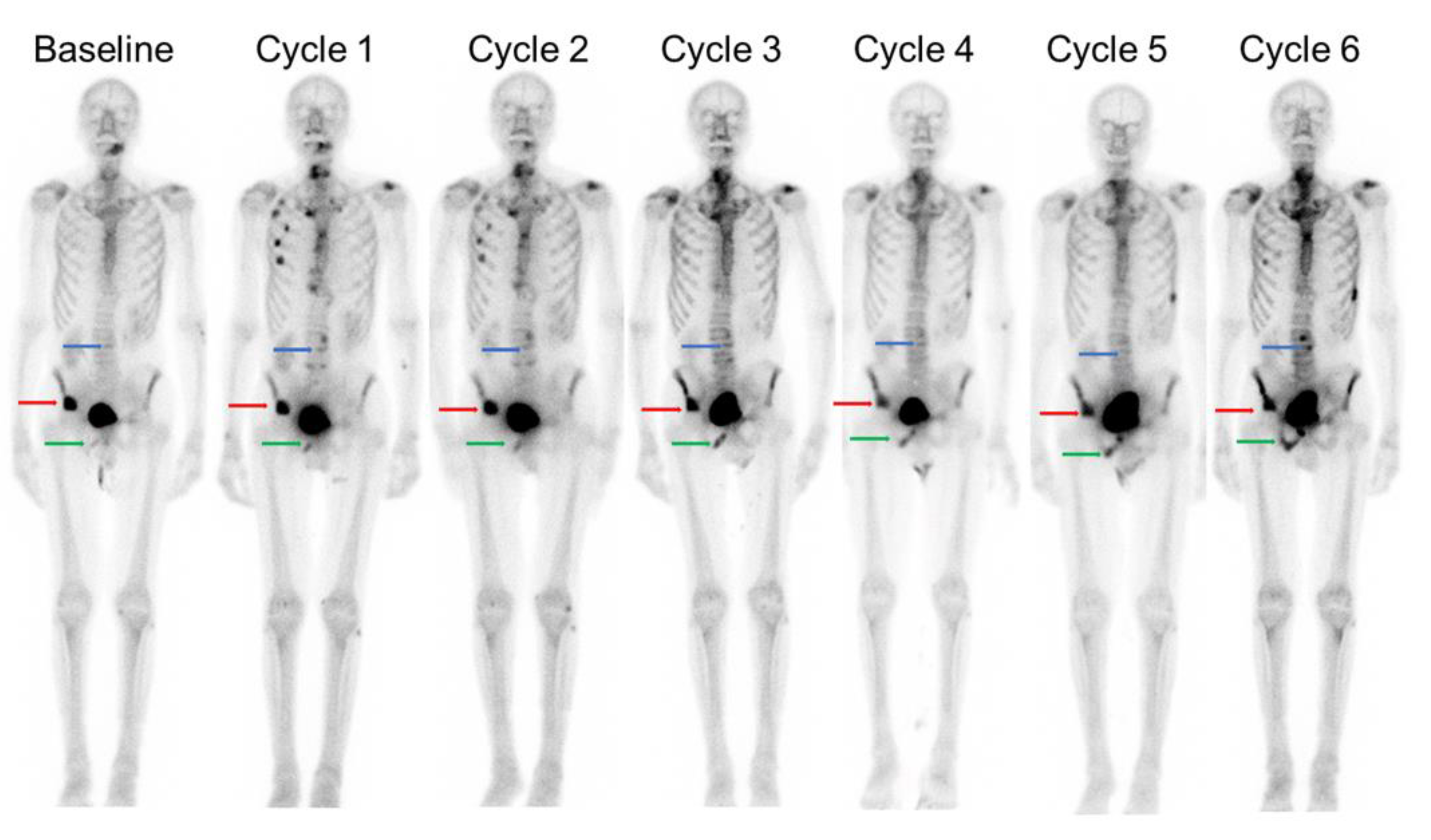 A Treatment Paradigm Shift: Targeted Radionuclide Therapies for ...