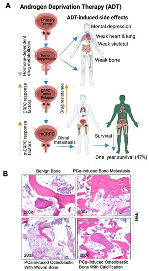 Bone Health Management in the Continuum of Prostate Cancer Disease