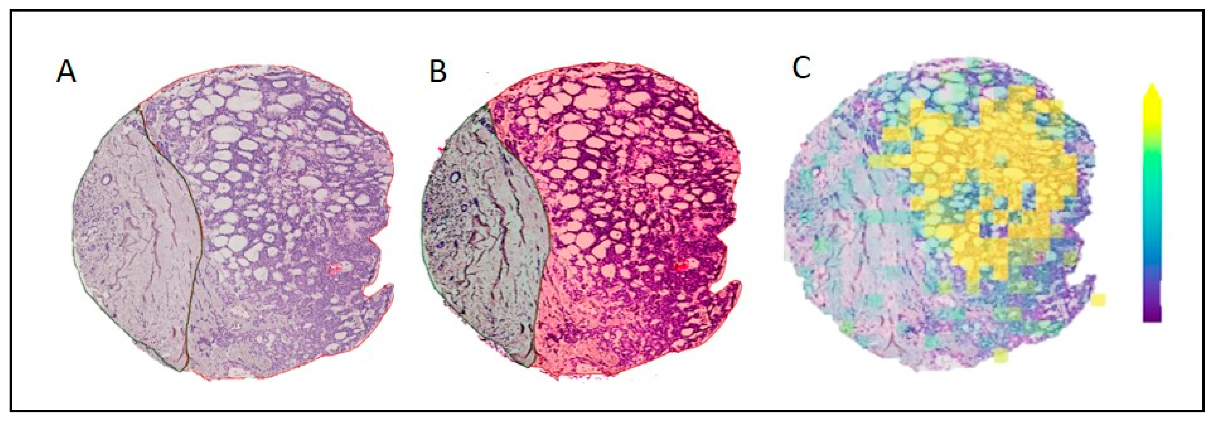 Multi-Class Cancer Subtyping in Salivary Gland Carcinomas with MALDI ...