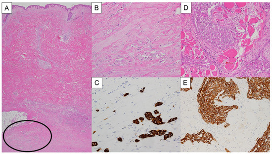Cancers | Free Full-Text | Incidence and Risk Factors of Chest Wall ...