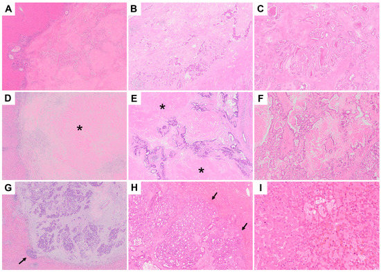 Pathological Evaluation of Resected Colorectal Liver Metastases ...