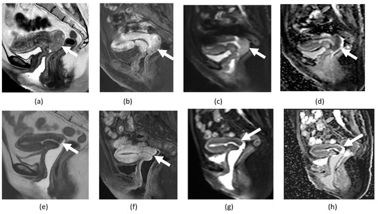 Utility of the Diffusion Weighted Sequence in Gynecological Imaging ...