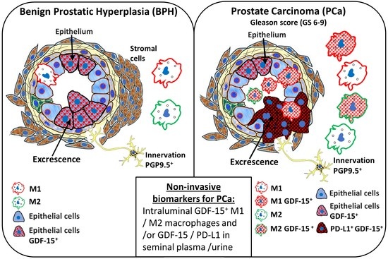Cancers | Free Full-Text | Increased Density of Growth Differentiation ...
