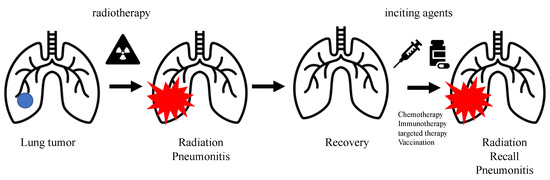 Radiation Recall Pneumonitis: A Rare Syndrome That Should Be Recognized