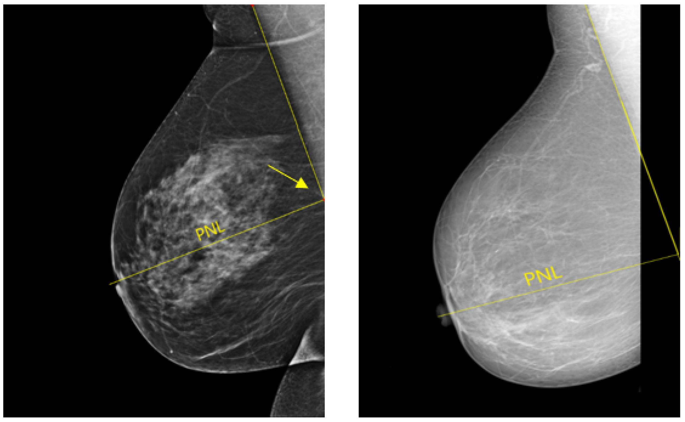 Cancers | Free Full-Text | Automated Assessment of Breast Positioning Quality in Screening ...