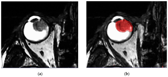 Cancers | Free Full-Text | Feasibility, Method and Early Outcome of ...