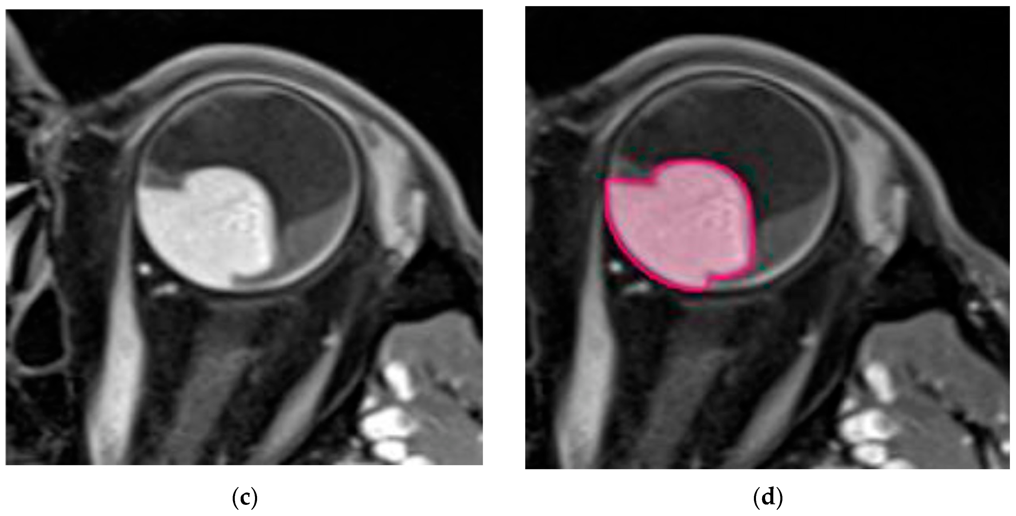 Cancers | Free Full-Text | Feasibility, Method and Early Outcome of ...