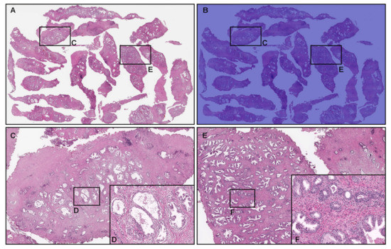 Transfer Learning for Adenocarcinoma Classifications in the Transurethral Resection of Prostate ...