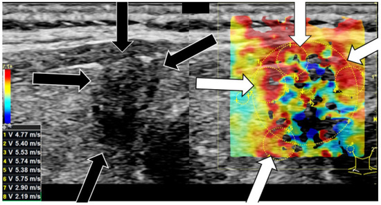 Multiparametric Sonographic Imaging of Thyroid Lesions: Chances of B ...