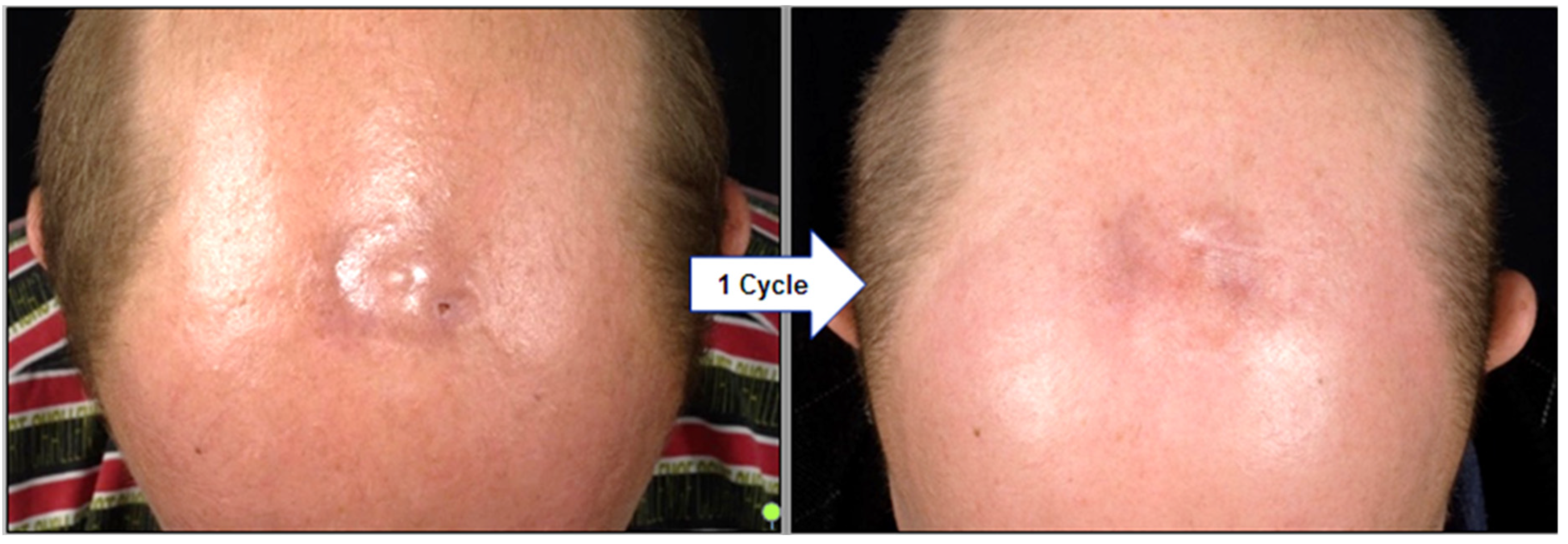 Cancers | Free Full-Text | Treatment of Indolent Cutaneous B-Cell Lymphoma with Intralesional or ...