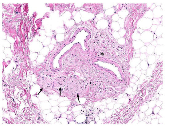 Nerve Density and Neuronal Biomarkers in Cancer