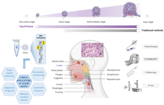 Neck Cancer Stages Head And Neck Cancers: Symptoms, Causes And