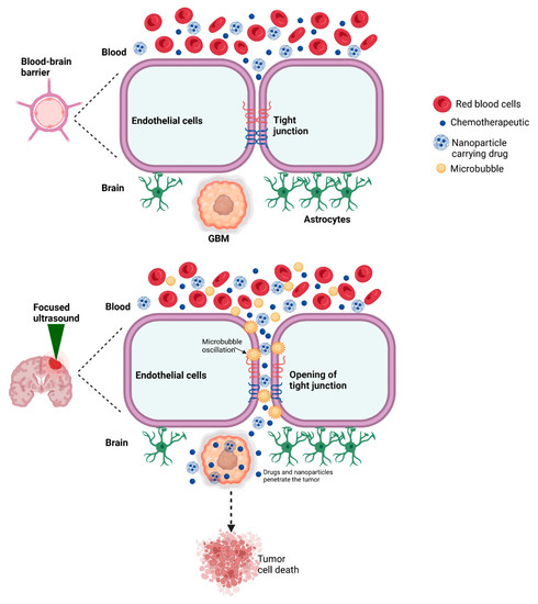 Applications of Focused Ultrasound for the Treatment of Glioblastoma: A New Frontier