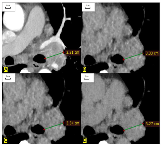 Measurement Accuracy and Repeatability of RECIST-Defined Pulmonary ...