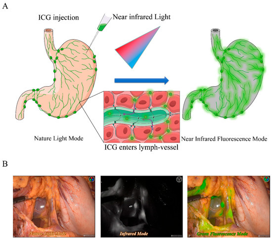 Mapping Lymph Node during Indocyanine Green Fluorescence-Imaging Guided Gastric Oncologic ...