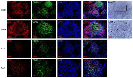 Effect of Tertiary Lymphoid Structures on Prognosis of Patients with ...
