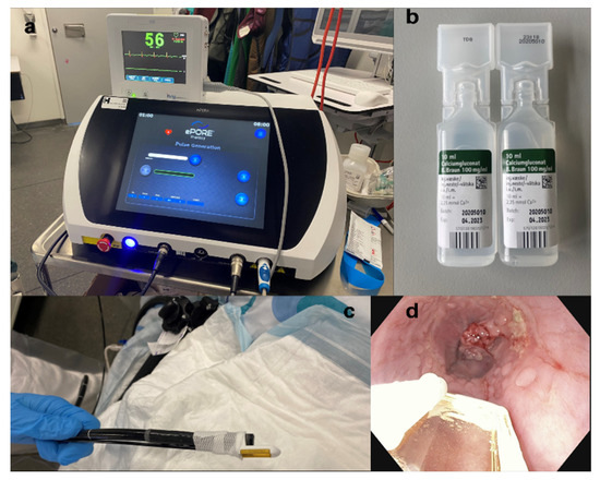 Palliative Treatment of Esophageal Cancer Using Calcium Electroporation