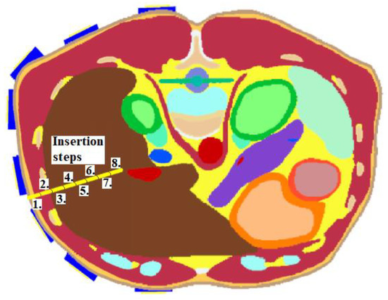 Microwave Catheter Navigation System for the Radiofrequency Liver Ablation