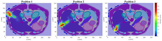 Microwave Catheter Navigation System for the Radiofrequency Liver Ablation