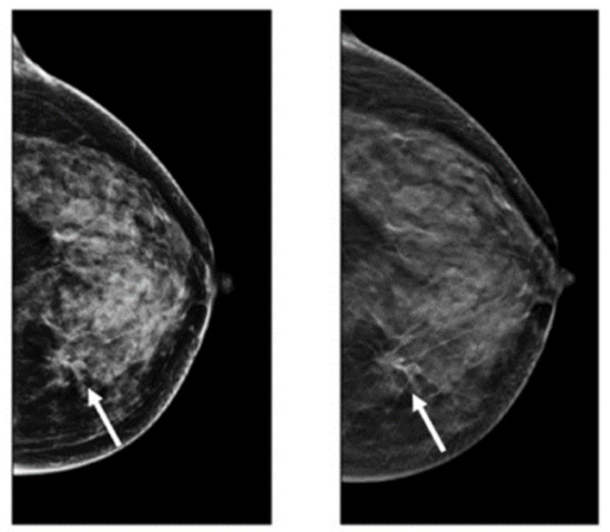 The Role of Deep Learning in Advancing Breast Cancer Detection Using ...