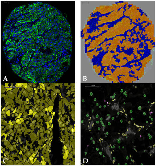 Use of High-Plex Data Reveals Novel Insights into the Tumour ...