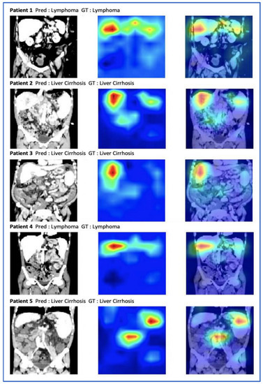 Two-Stage Deep Learning Model for Automated Segmentation and Classification of Splenomegaly