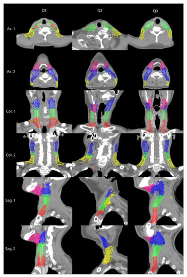 Deep Learning for Automated Elective Lymph Node Level Segmentation for Head and Neck Cancer ...
