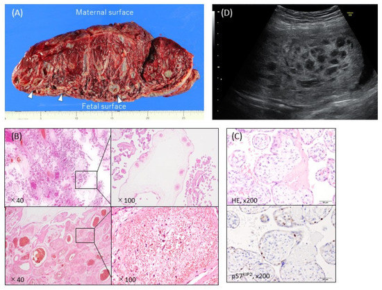 Placental Mesenchymal Dysplasia and Beckwith–Wiedemann Syndrome