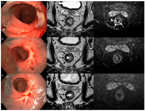 Features on Endoscopy and MRI after Treatment with Contact X-ray ...