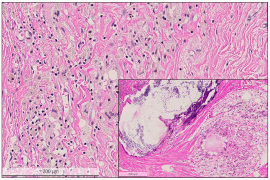 Next Generation Sequencing of Reactive Stroma and Residual Breast ...