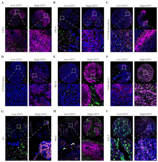 Identification of CD73 as a Novel Biomarker Encompassing the Tumor ...