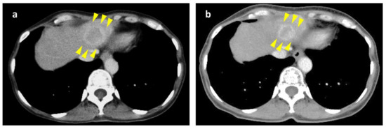 Clinical Outcomes of Everolimus Rechallenge in Patients with Pancreatic ...