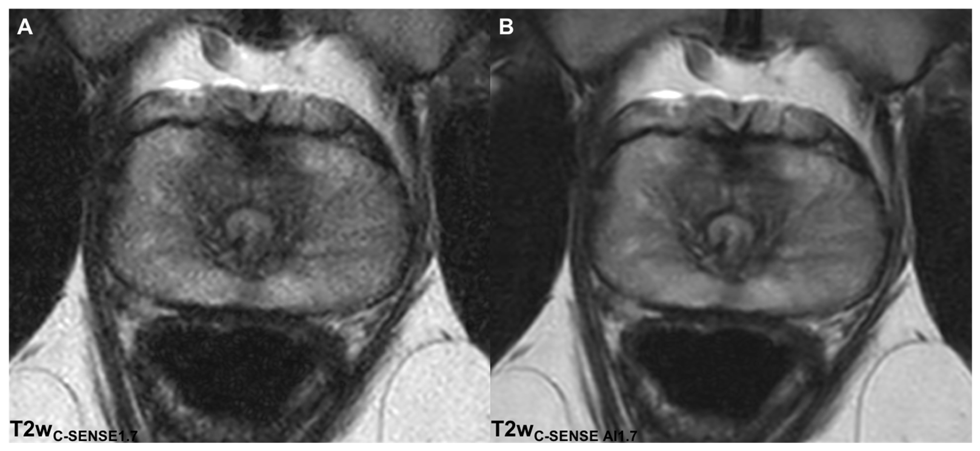 Cancers Free Full Text Prospectively Accelerated T2 Weighted