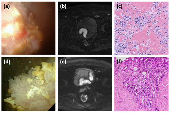 Does Bladder Cancer with Inchworm Sign Indicate Better Prognosis after ...