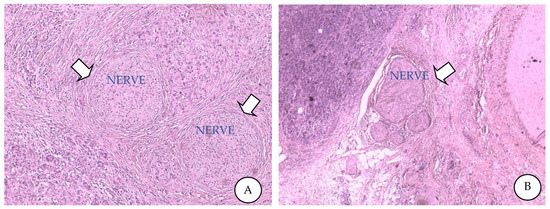 Cancers | Free Full-Text | Perineural Invasion in Pancreatic Ductal Adenocarcinoma: From ...
