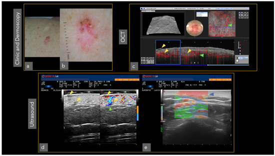 Diagnostics Using Non-Invasive Technologies in Dermatological Oncology