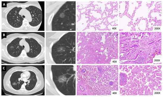 Cancers | Free Full-Text | CT-Based Radiomic Analysis for Preoperative ...